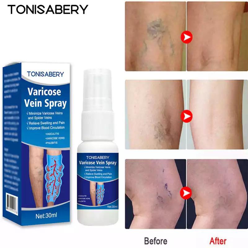 SG Ready Stock TONISABERY Varicose Vein Spray Relief Veins Minimize ...