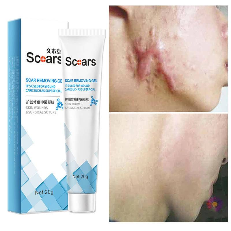 SCOARS Herbal Acne Scar Removal Cream Stretch Marks Remove Face Body Burn Surgical Scars ...