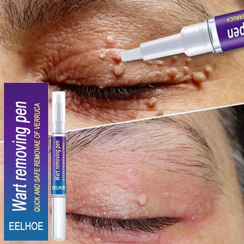 EELHOE Skin Tag Remover Eliminate Warts Remover Cream Body Mole Wart ...