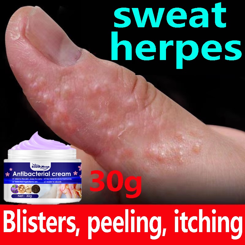 Y98 3 Seconds To Relieve ItchingSweat Herpes Treatment 30g Blisters ...
