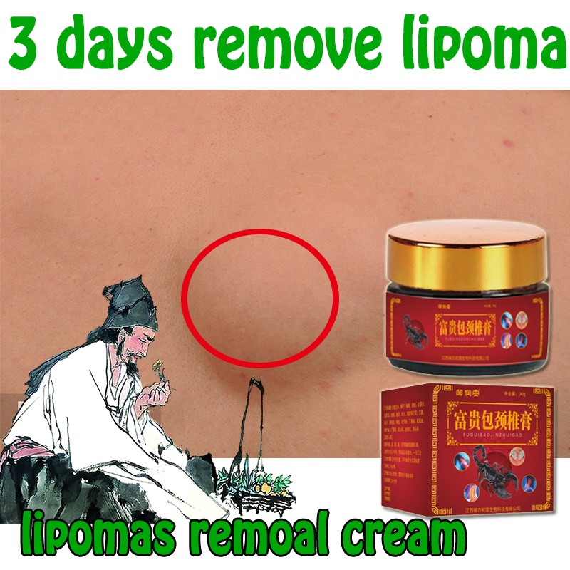 50g lipoma removal cream gamot sa bukol lipoma remover removal japan lipomas for goiter | Shopee ...