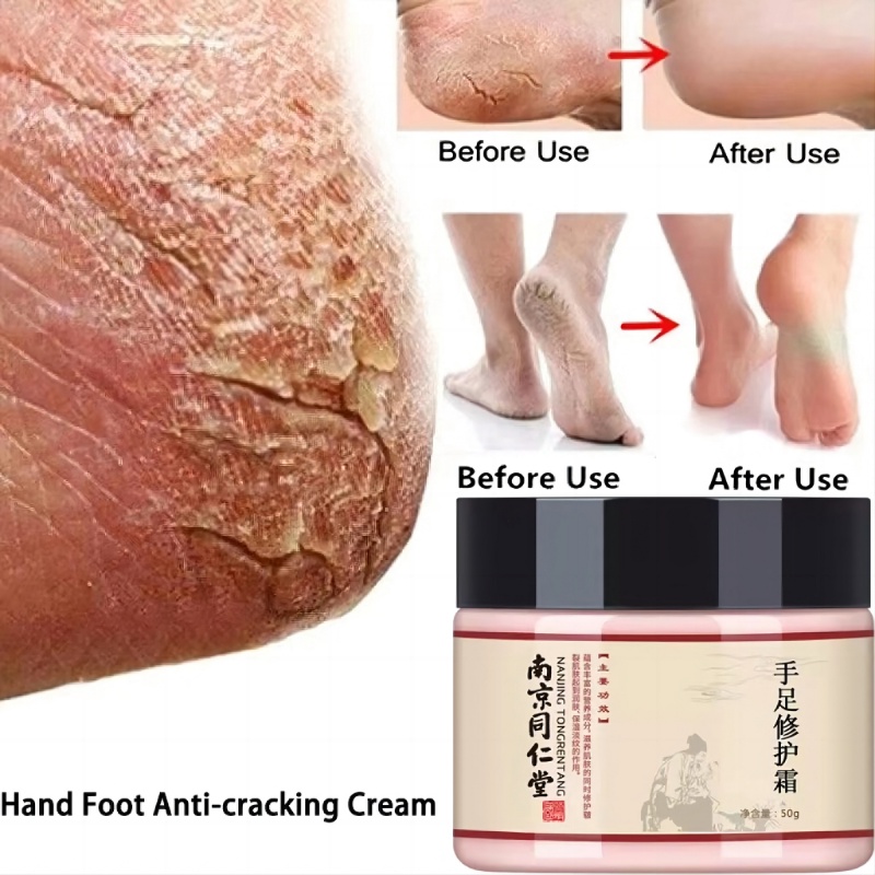 Foot Cream Anti-crack Dry Skin Foot Hand Moisturiser Skin Repairing ...