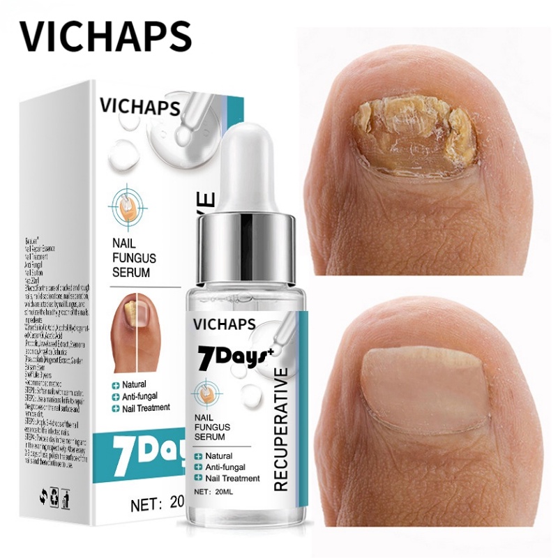 7 Days Nail Fungus Treatment Repair Serum Anti-Infective Onychomycosis ...
