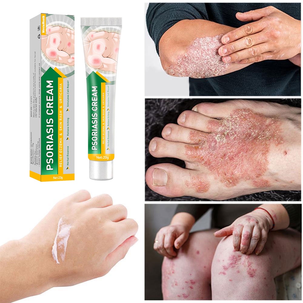 Eczema Psoriasis Dermatitis Ointment Herbal Antibacterial Anti Itchy