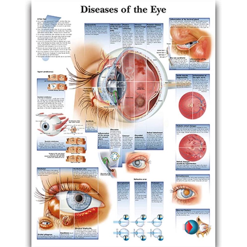 Goood Diseases of the Eye Anatomy Posters for Walls Nursing Students ...