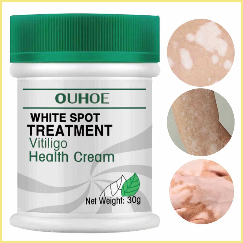 30g Effective Herbal Extract Vitiligo Repair Cream Ointment Remove ...