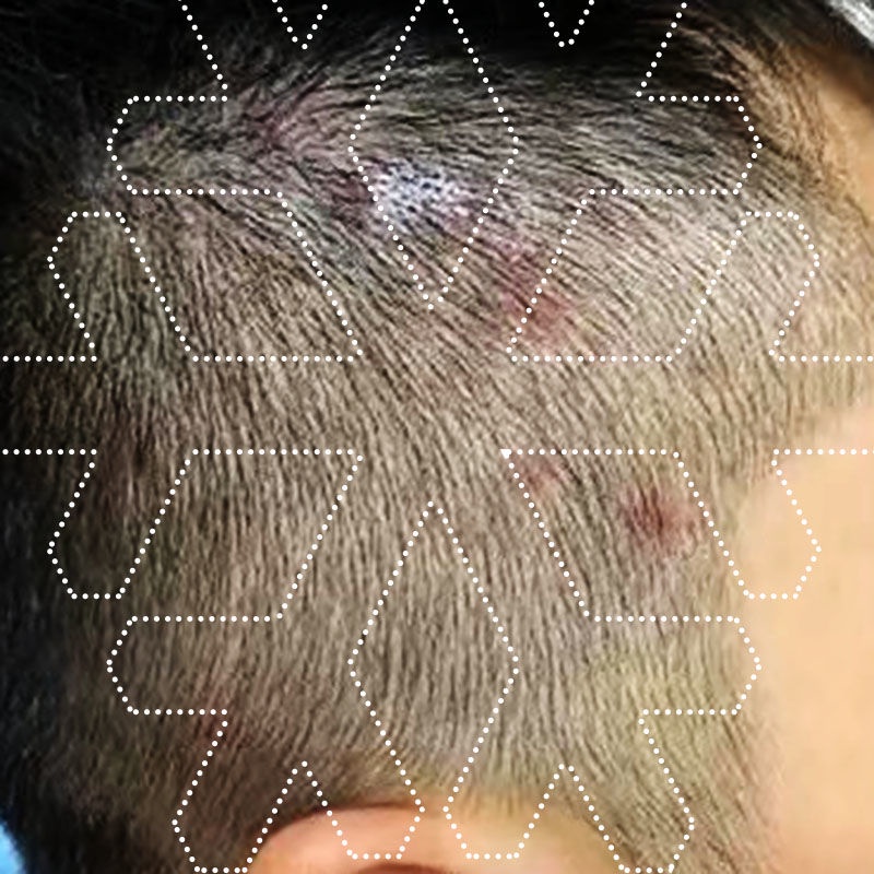 Head folliculitis pustules bumps scalp itchy scalp dandruff have blain ...