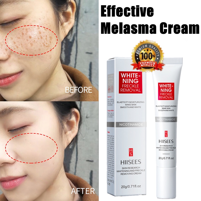 HIISEES Effective Melasma Cream 20g Freckles removal dark spots age ...