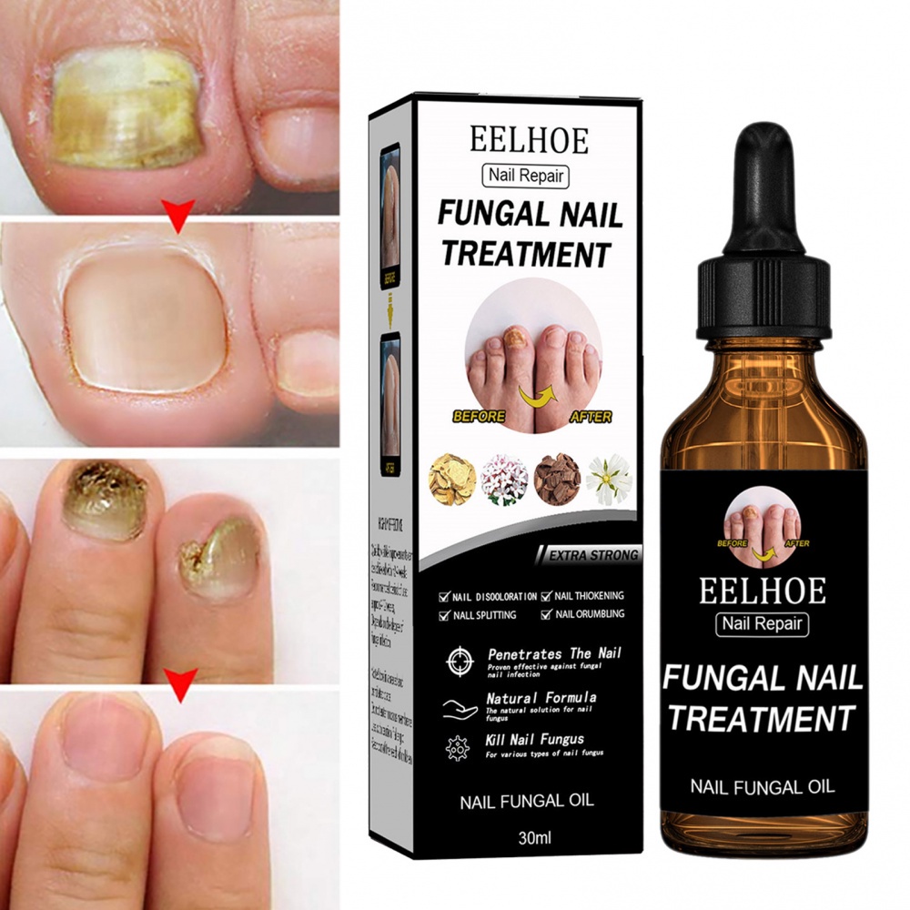 Nail Fungus Treatments Serum Foot Care Serum Toe Nails Fungal Removal ...