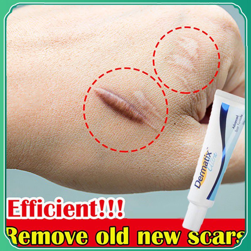 Dermatix Advance Scar Dermatix Ultra Scar Gel Scar Remover Cream Ubat ...