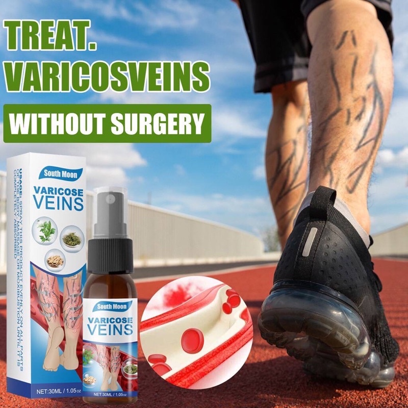 Varicose Veins Treatment Spray Effective Cure Vasculitis Varicose Vein ...
