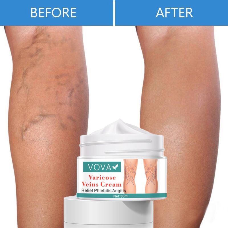 🔥[SPECIAL OFFER]🔥Varicose Veins Relief Cream Relieve Vascular Swelling ...