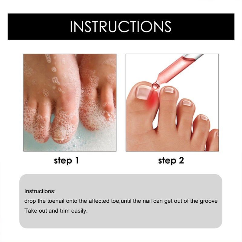 10ml Ingrowth Toenail Correction Treatment Oil, Ingrown Toenail Drops ...