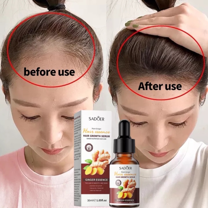 SADOER Hair Growth Fluid Ginger Fast Hair Growth Serum Repair Damaged ...