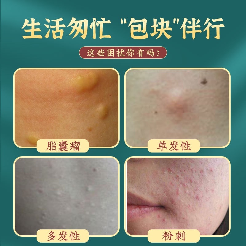 《hot》 Lipoma Cream 30g Ointment Fat Granule Care Lipoma Subcutaneous ...