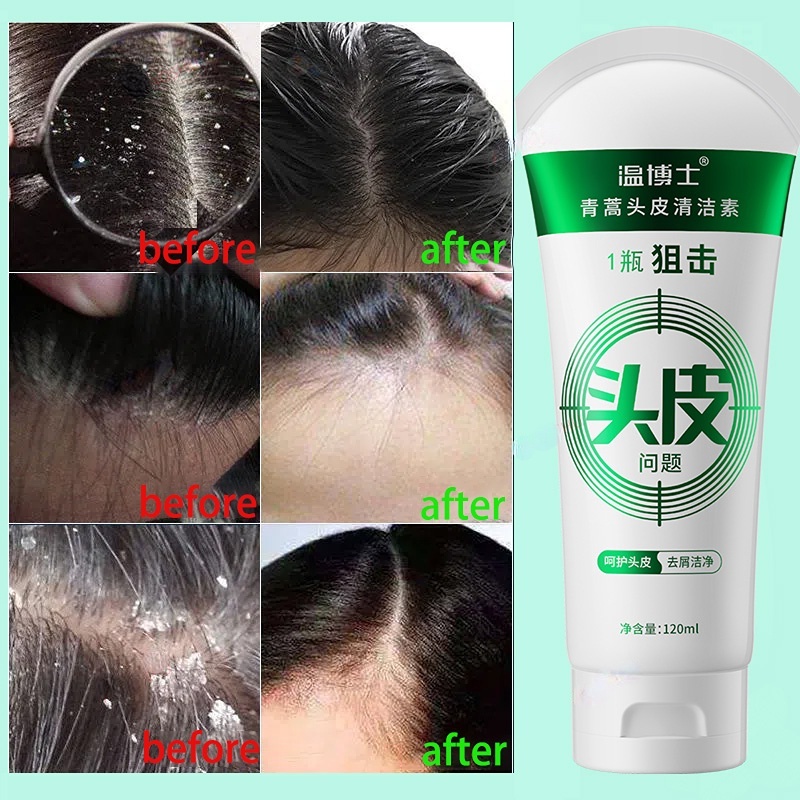 Scalp Cleansing Shampoo Anti Dandruff Remove Mite Shampoo Hair Fall ...
