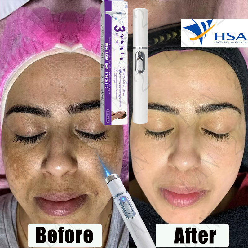 【Low pulse laser for freckle removal】Remove chloasma and freckles ...