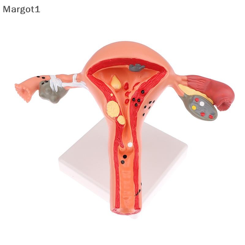 [Margot1] 1Pcs Medical Props Model Pathological Uterus Ovary Anatomical ...