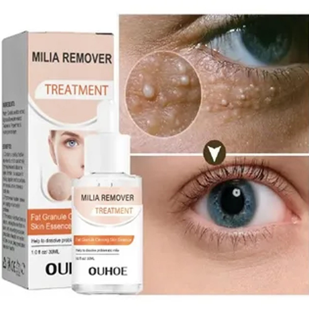 Milia seed remover fat granule Syringoma Milia remover grease grains ...