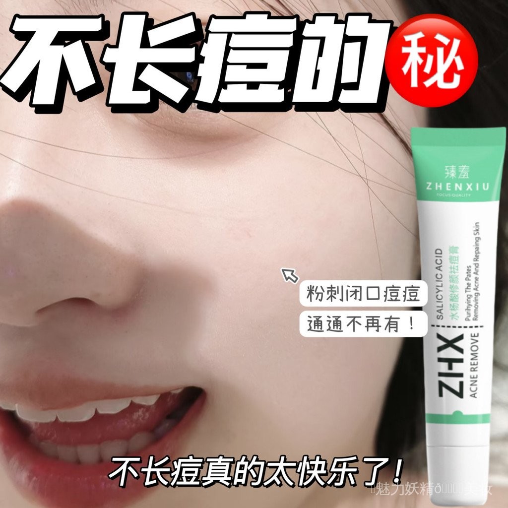 Acne cream Acne Removal Magic Tool Plaster King Smallpox Diluting Pox ...