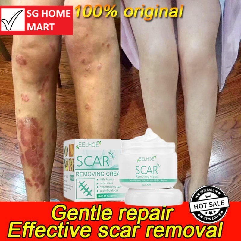 Scar Remover Cream Peklat 30ml Repair Skin Care Stretch marks Burn Scar ...
