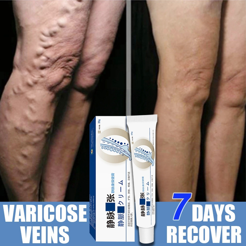 【Japan】Varicose Veins Effective Remover Cream 20g Dedicated Treatment ...