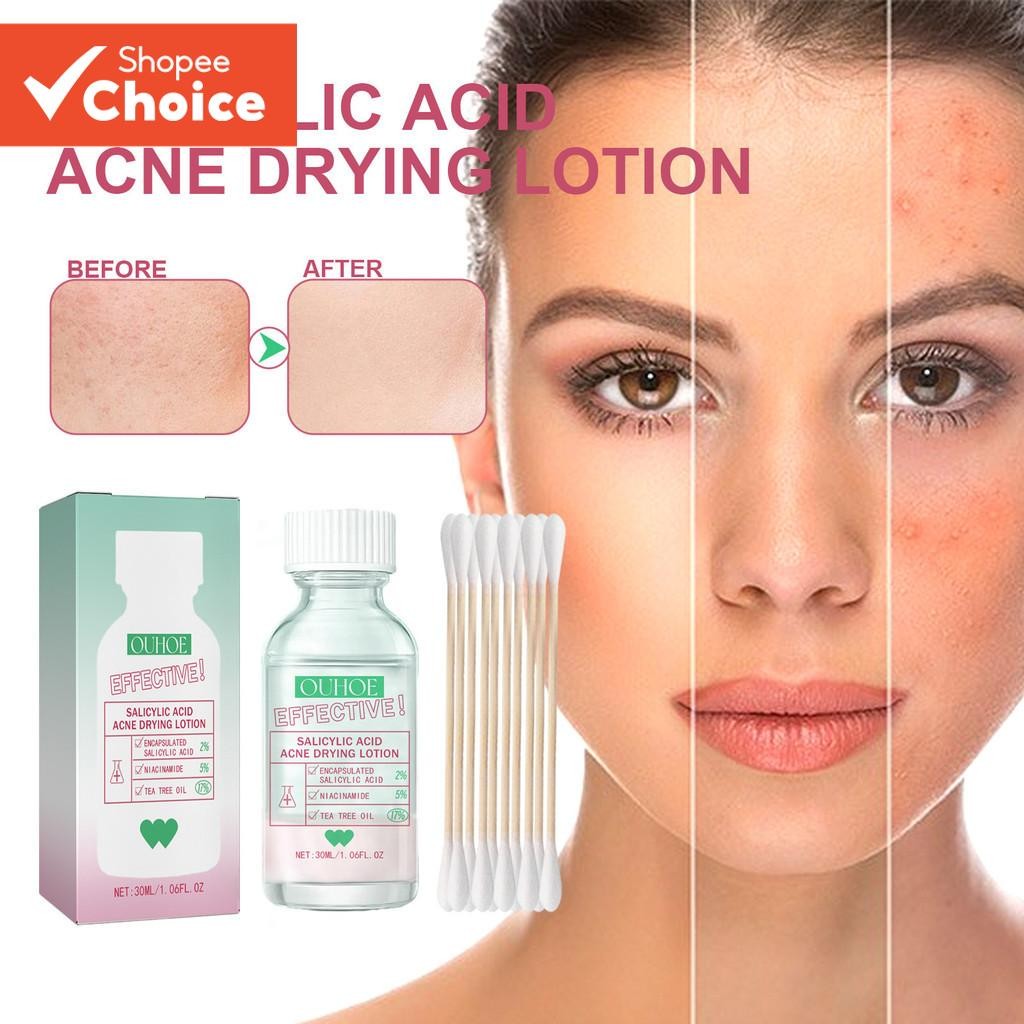Ouhoe Salicylic Acid Acne Drying Lotion Gently Repair Acne-Prone ...