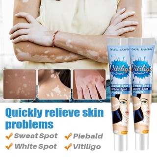 SOL LORA Vitiligo Cream Remove White Spot Removal Cream Vitiligo Skin ...