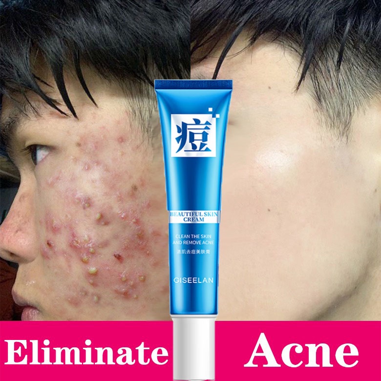 Acne Cream Anti Acne Cream Acne Treatment Serum Acne Treatment Gel Scar Removal Cream Pimples