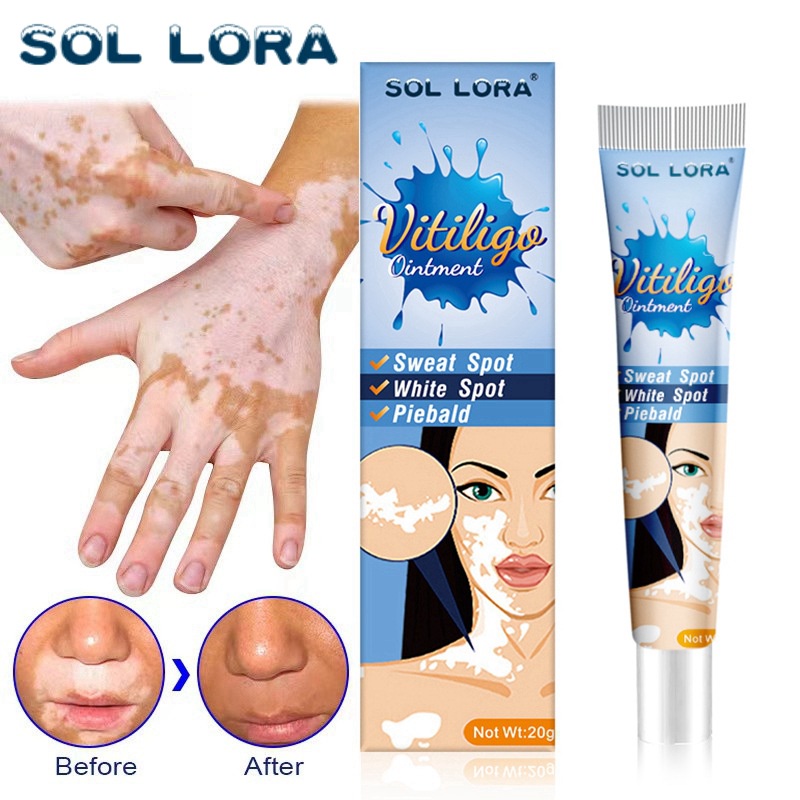 SOL LORA Vitiligo Cream Remove White Spot Removal Cream Vitiligo Skin Recovery Cream 20g 花斑护理保健膏 ...