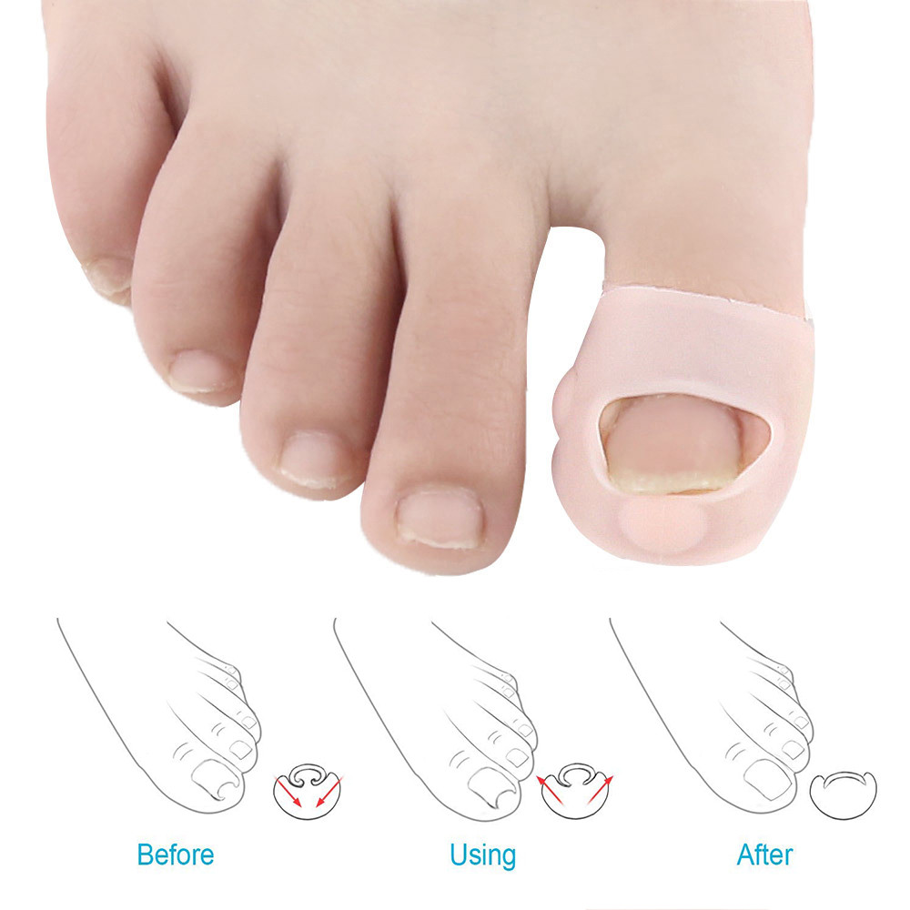 2/Pcs Toe Protector Protect Toe from Rubbing Ingrown Toenails Corns ...