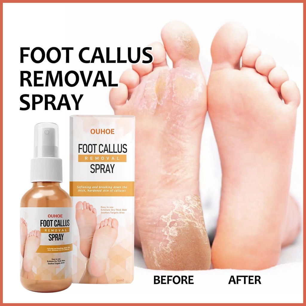 Foot Callus Removal 1.01 Oz Dry Feet Skin Remover Foot Peel Remover ...