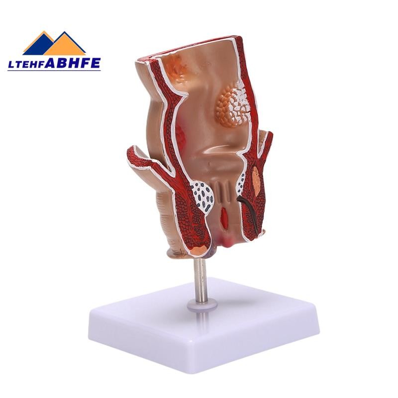 Anatomy Model Human Rectal Hemorrhoid Lesion Model Hemorrhoid Fistula ...