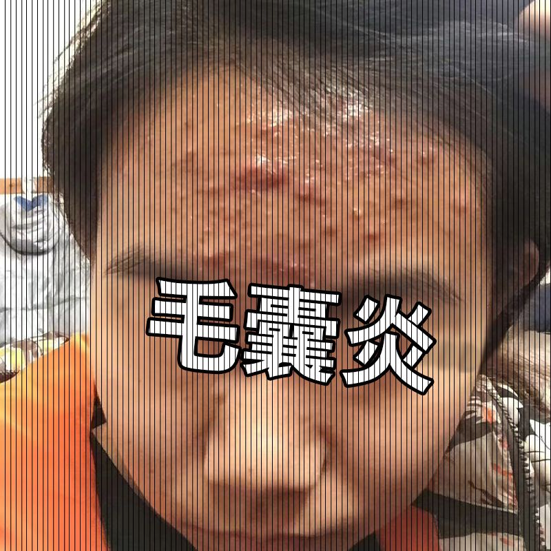 ☜Severe folliculitis, head, forehead, acne, pustules, hair follicles ...