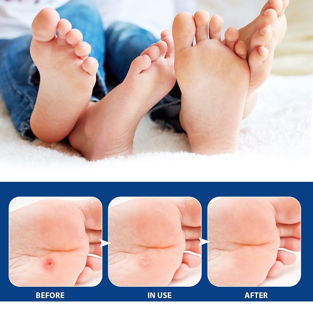 [shinyheaven.sg] 24pcs Corn Removal Sticker Painless Medical Plaster ...