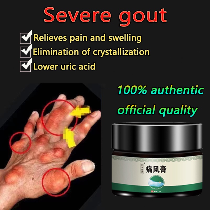 Gout Ointment Ubat Gout 35g Natural Chinese Herbal Medicine Gout ...