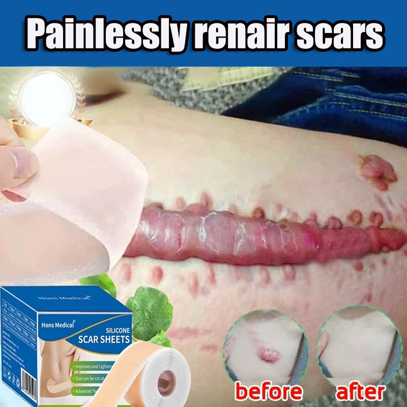 Remove Scars Scar Gel/Keloid Scar Plaster/Scar Removal Patch Reusable ...