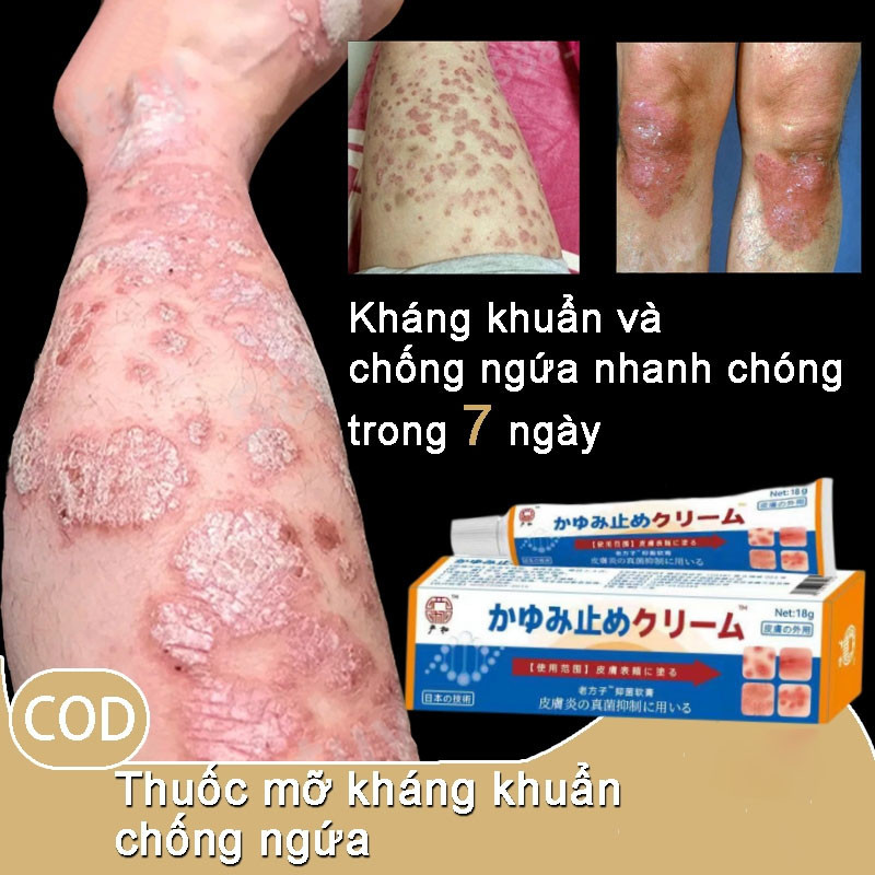 Japan Itchy Fungus Topical Cream Supports Ringworm, Psoriasis, Ringworm ...