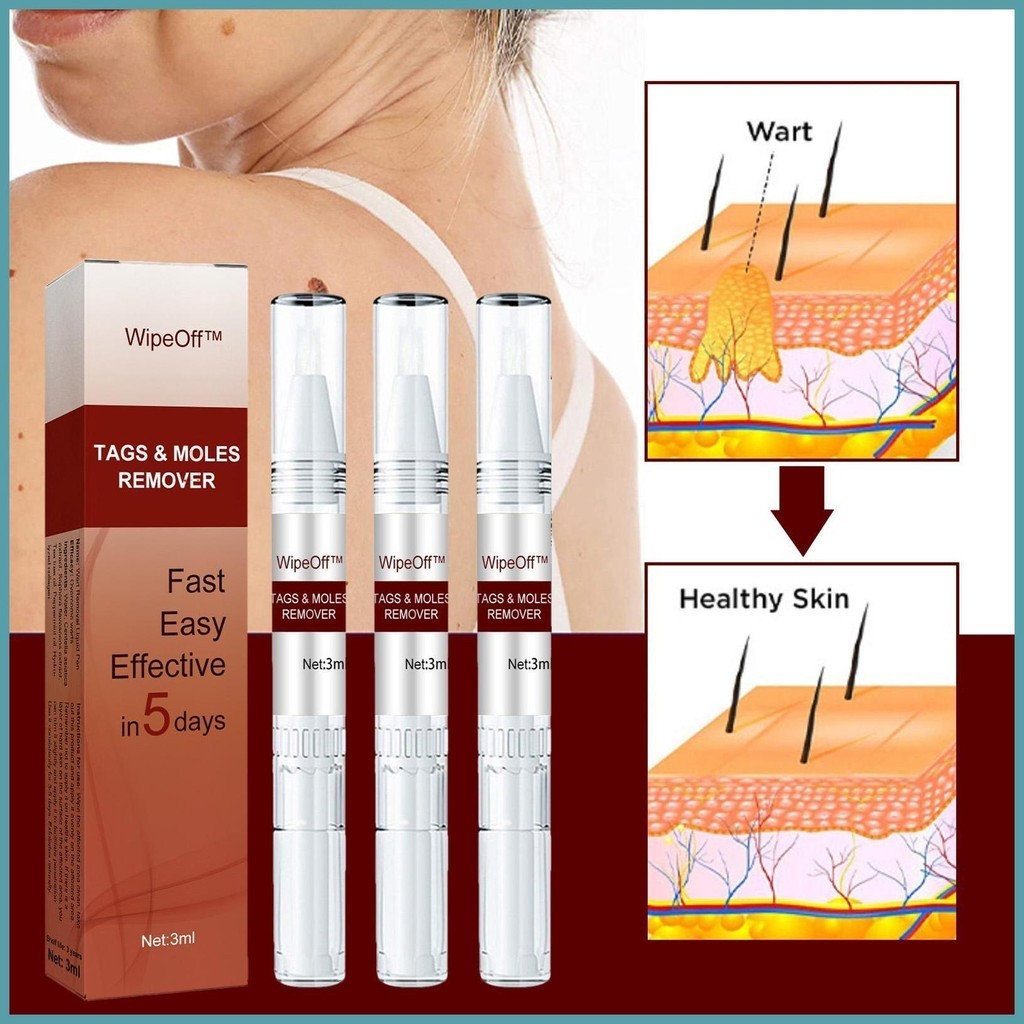 Wipe Off Moles Remover Wipe Off Tags & Moles Remover Non-Irritating ...