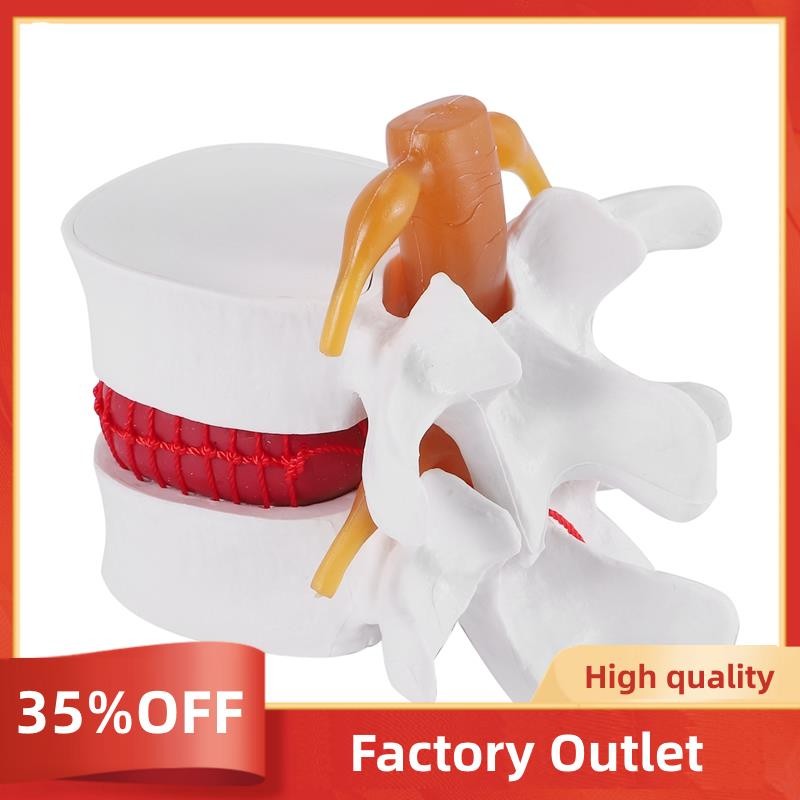 1:1.5 Human Lumbar Disc Herniation Demonstration Model of Lumbar ...