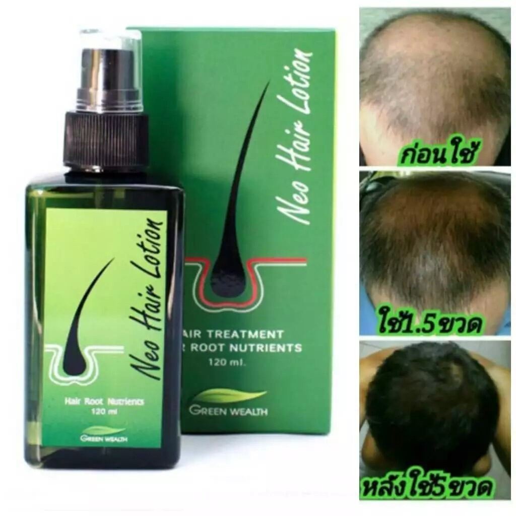 NEO HAIR LOTION ORIGNAL SPRAY 100% Hair Transplant and Hair Loss ...