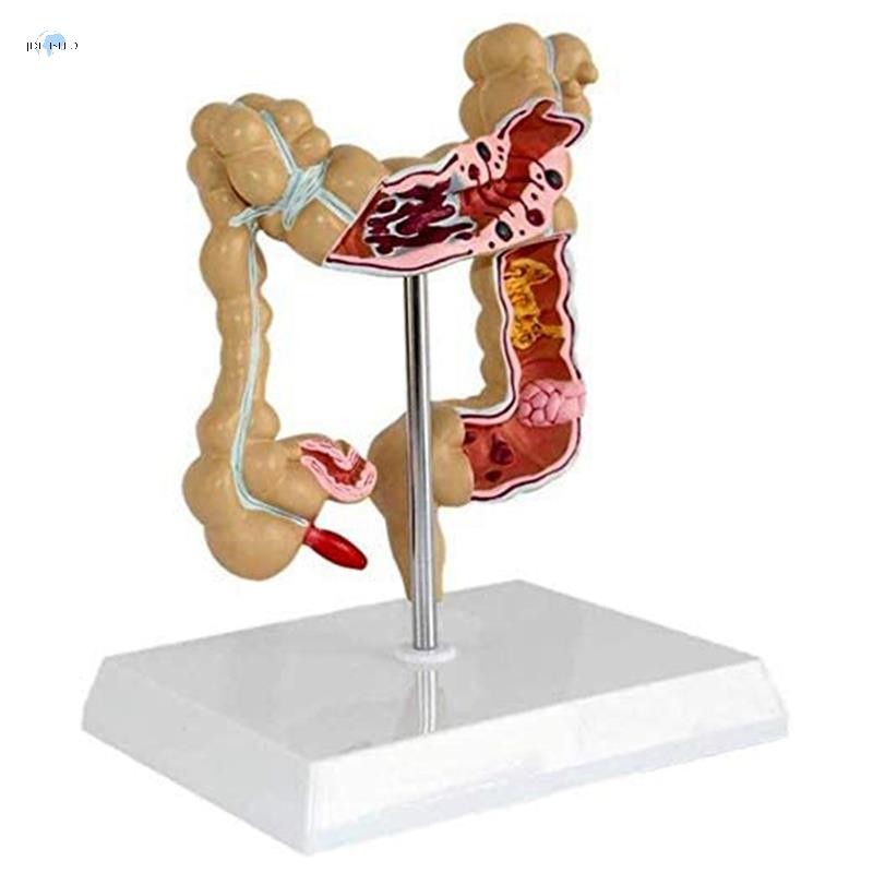 Pathological Colorectal Model Large Intestine Model Gastrointestinal ...