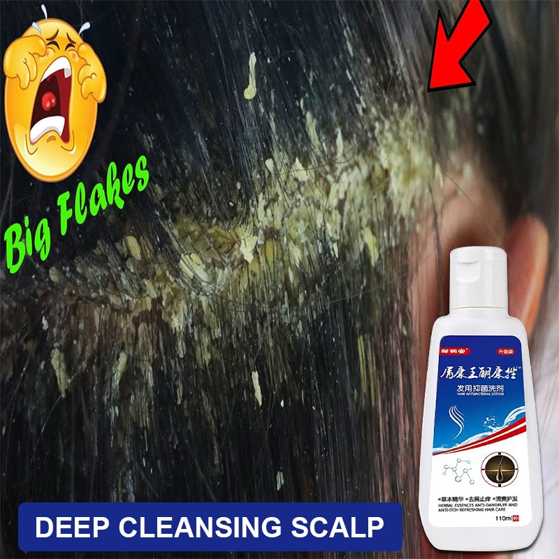 Anti Dandruff shampoo Scalp Treatment Ketoconazole Cleaning Lotion 110ml antibacterial anti ...