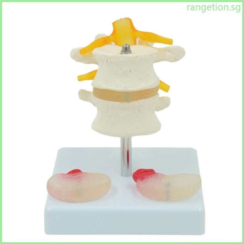 RAN Human Lumbar Spine Model Removable for Demonstrating Pathological ...