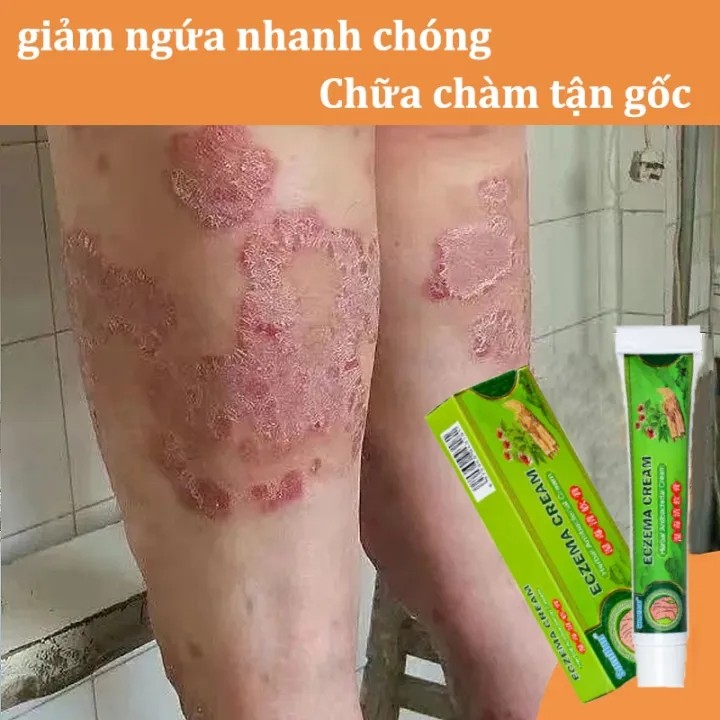 Topical cream for horny skin, cracked heels, rashes, ringworm ...