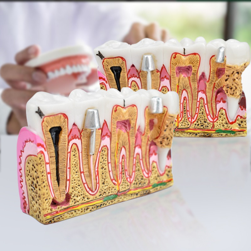 Tooth Model Dental Caries Anatomy Comprehensive Pathology Tooth Nerve ...