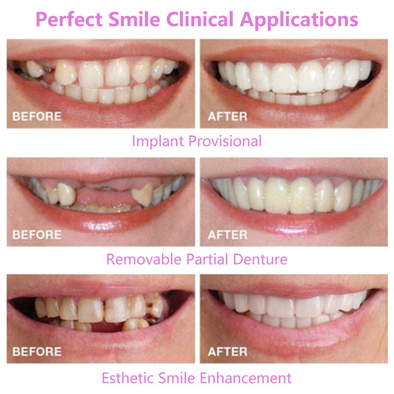 2 Pcs Perfect Fit Teeth Fake Tooth Cover Snap On Silicone Smile Veneers ...