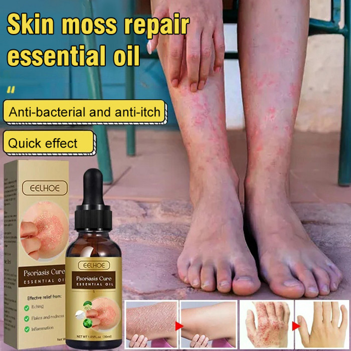 Skin Moss Essential Oil Hand and Foot Itch Relief Topical Swelling ...