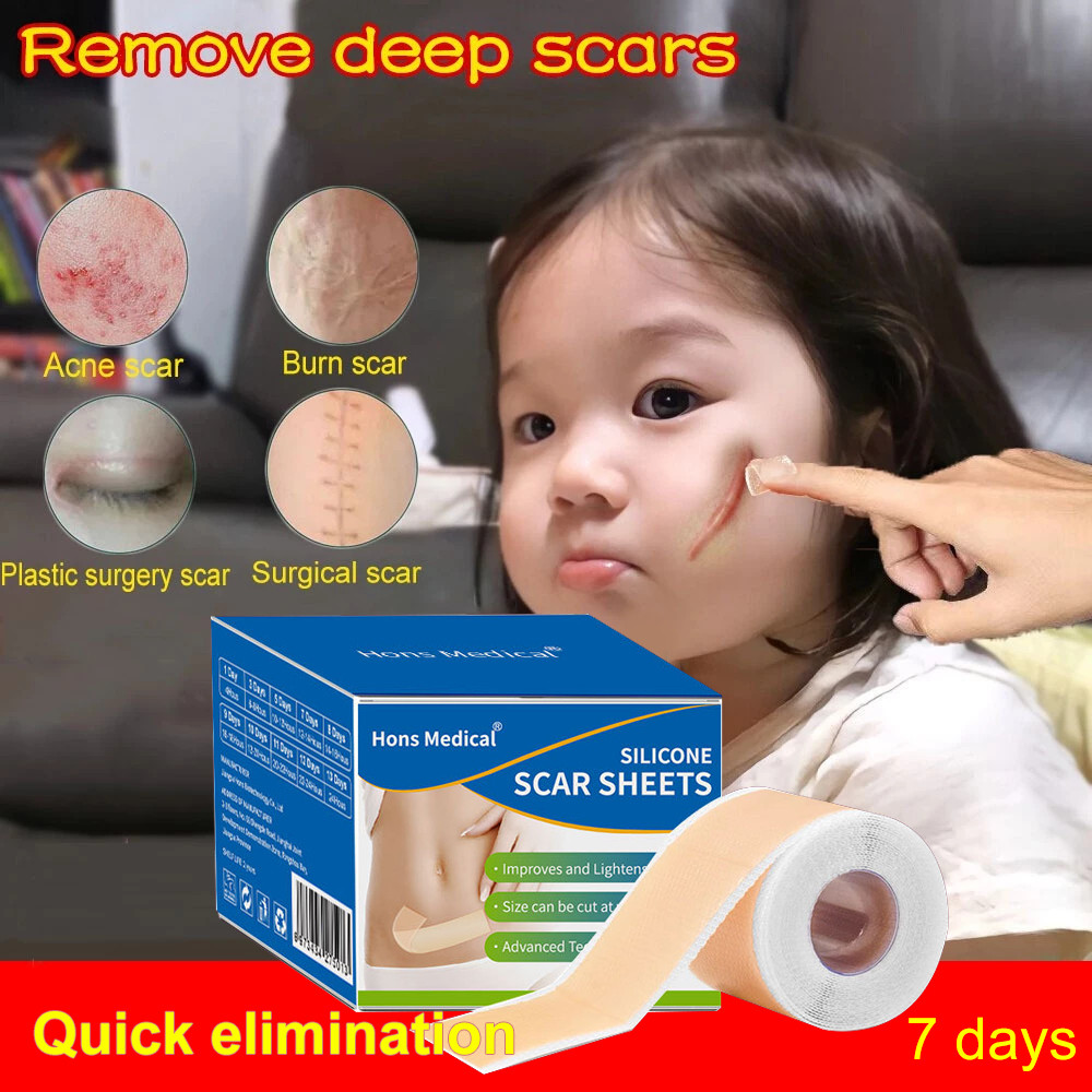 Scar Removal Medical Silicone Scar Sheet 4cmx50cm Scar Gel/Keloid Scar ...