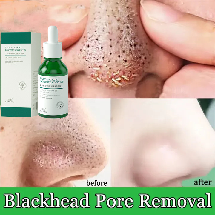 Pore Minimizer Serum Pore Contraction 30ml Pore Remover Salicylic Acid ...